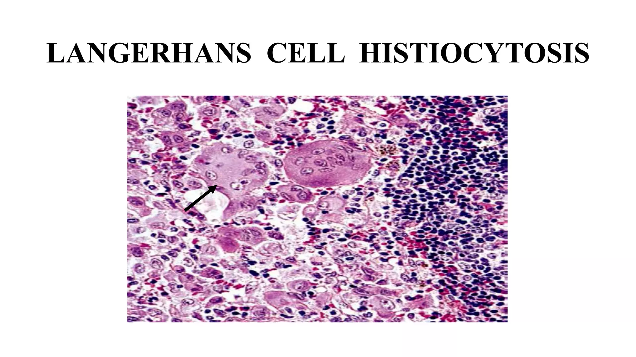 Meghana neoplastic lesions of lymph node - part 2 | PPT