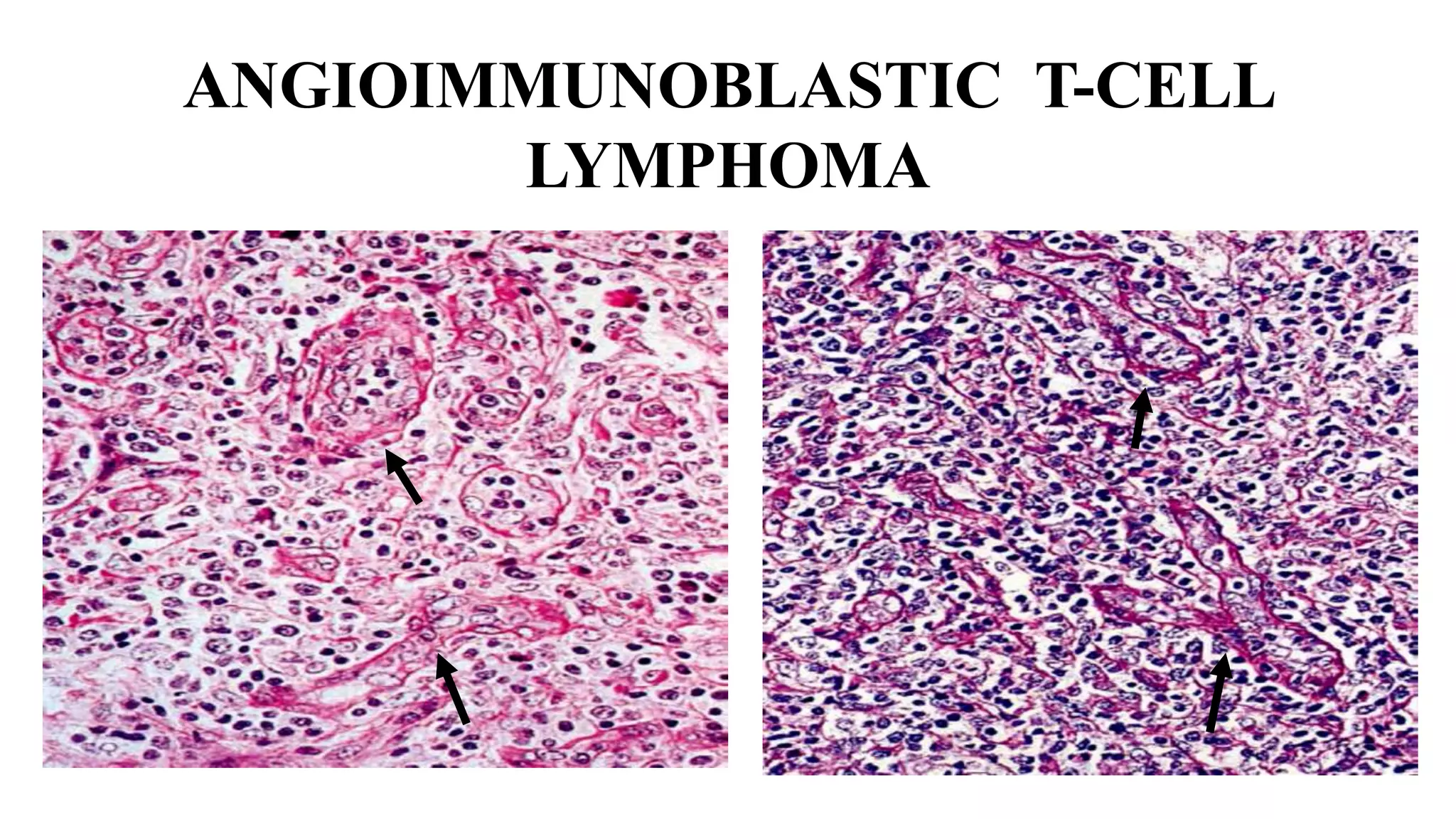 Meghana neoplastic lesions of lymph node - part 2 | PPTX | Cancer ...