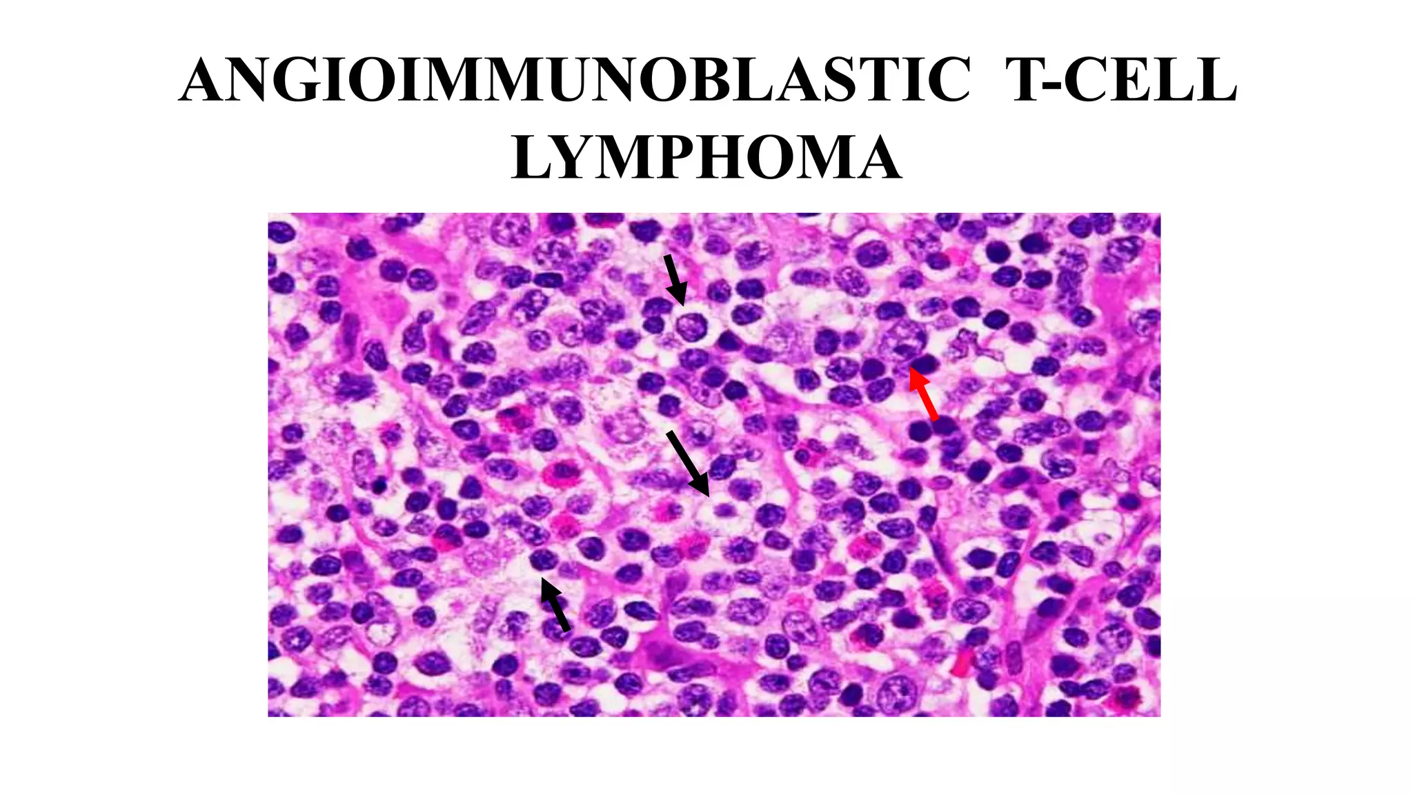 Meghana neoplastic lesions of lymph node - part 2 | PPTX | Cancer ...