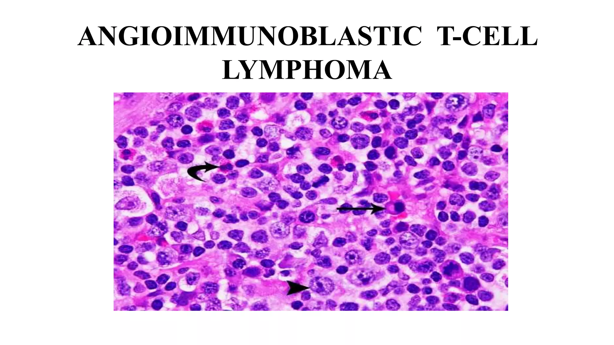 Meghana neoplastic lesions of lymph node - part 2 | PPTX | Cancer ...
