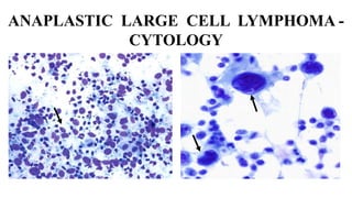 Meghana neoplastic lesions of lymph node - part 2 | PPTX