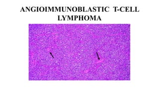 Meghana neoplastic lesions of lymph node - part 2 | PPTX
