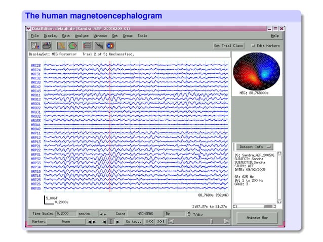 MEG recording of brain signals | PDF