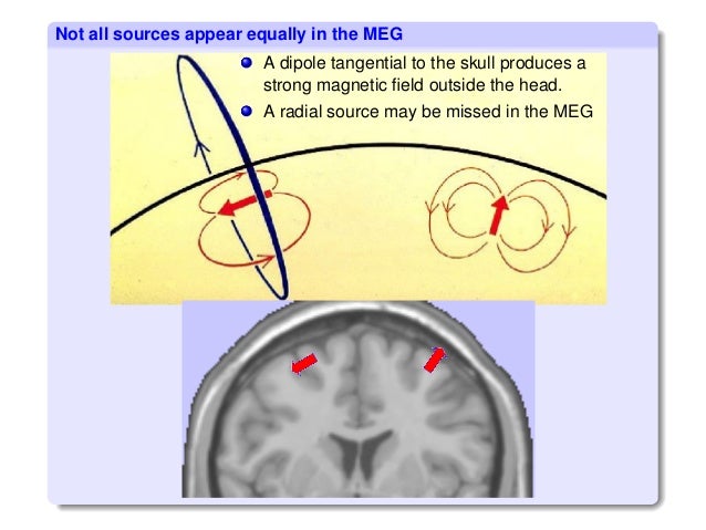 MEG recording of brain signals