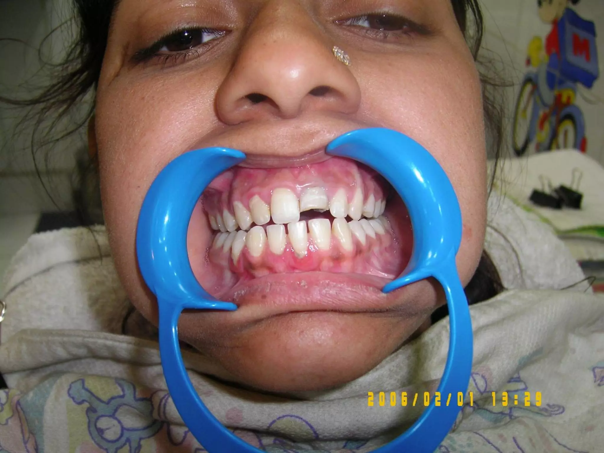 composite filling | PPT