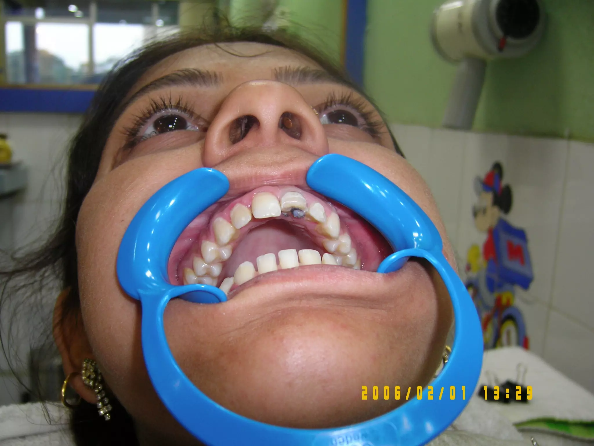 composite filling | PPT