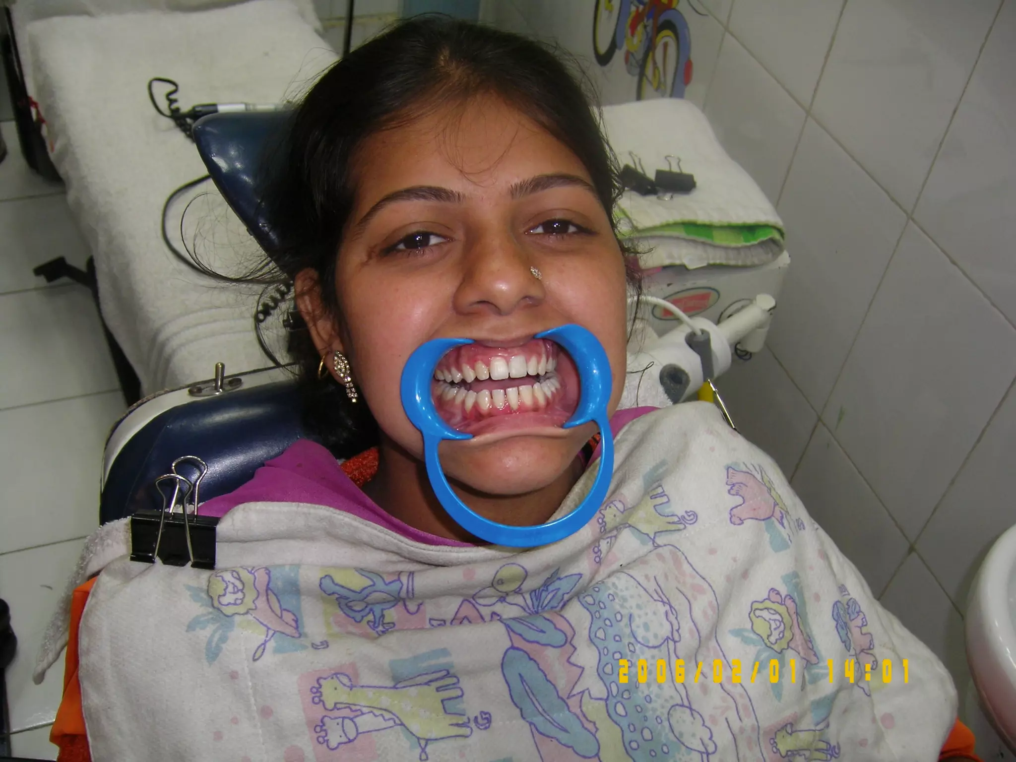 composite filling | PPT