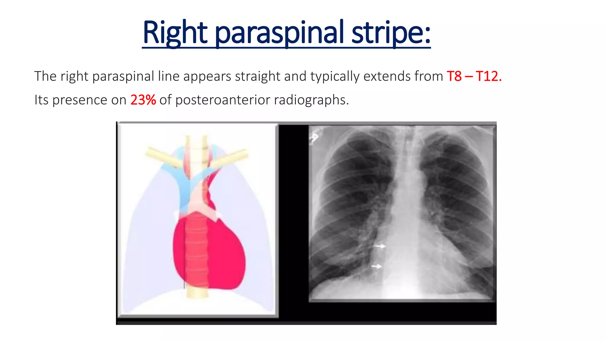 Radioanatomy of mediastinum and approach to mediastinal masses | PPTX