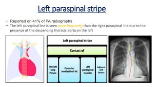 Radioanatomy of mediastinum and approach to mediastinal masses | PPTX