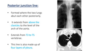 Radioanatomy of mediastinum and approach to mediastinal masses | PPTX