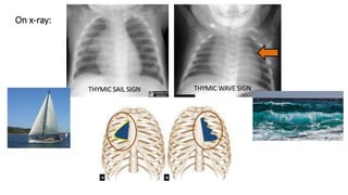 Radioanatomy of mediastinum and approach to mediastinal masses | PPTX