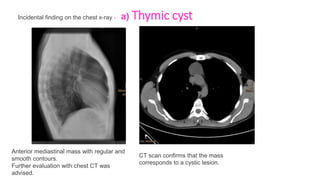 Radioanatomy of mediastinum and approach to mediastinal masses | PPTX