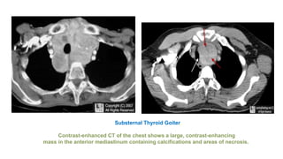 Radioanatomy of mediastinum and approach to mediastinal masses | PPTX