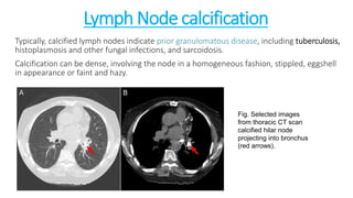 Radioanatomy of mediastinum and approach to mediastinal masses | PPTX