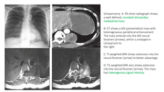 Radioanatomy of mediastinum and approach to mediastinal masses | PPTX