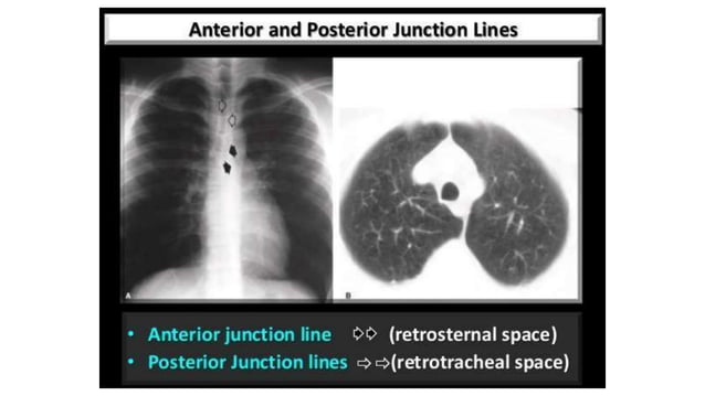 Radio anatomy and approach of mediastinalmasses.pptx