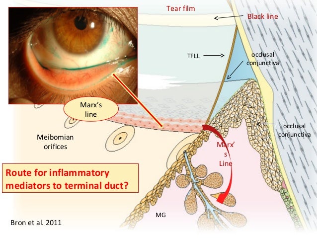 Prof Bron lecture. The A-Z of MGD