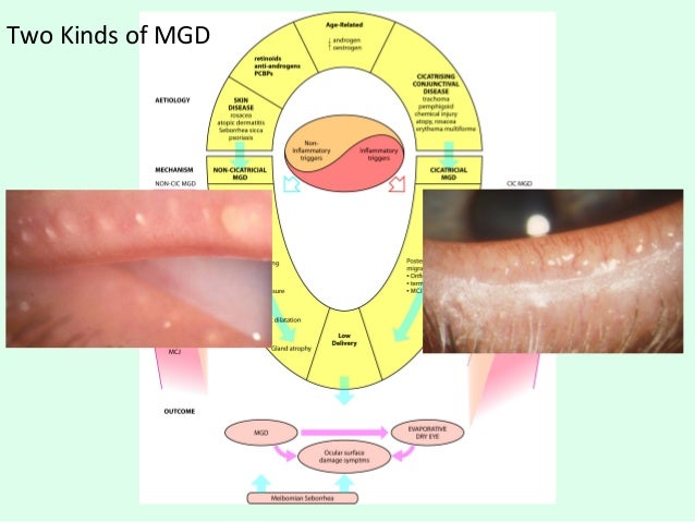 Prof Bron lecture. The A-Z of MGD