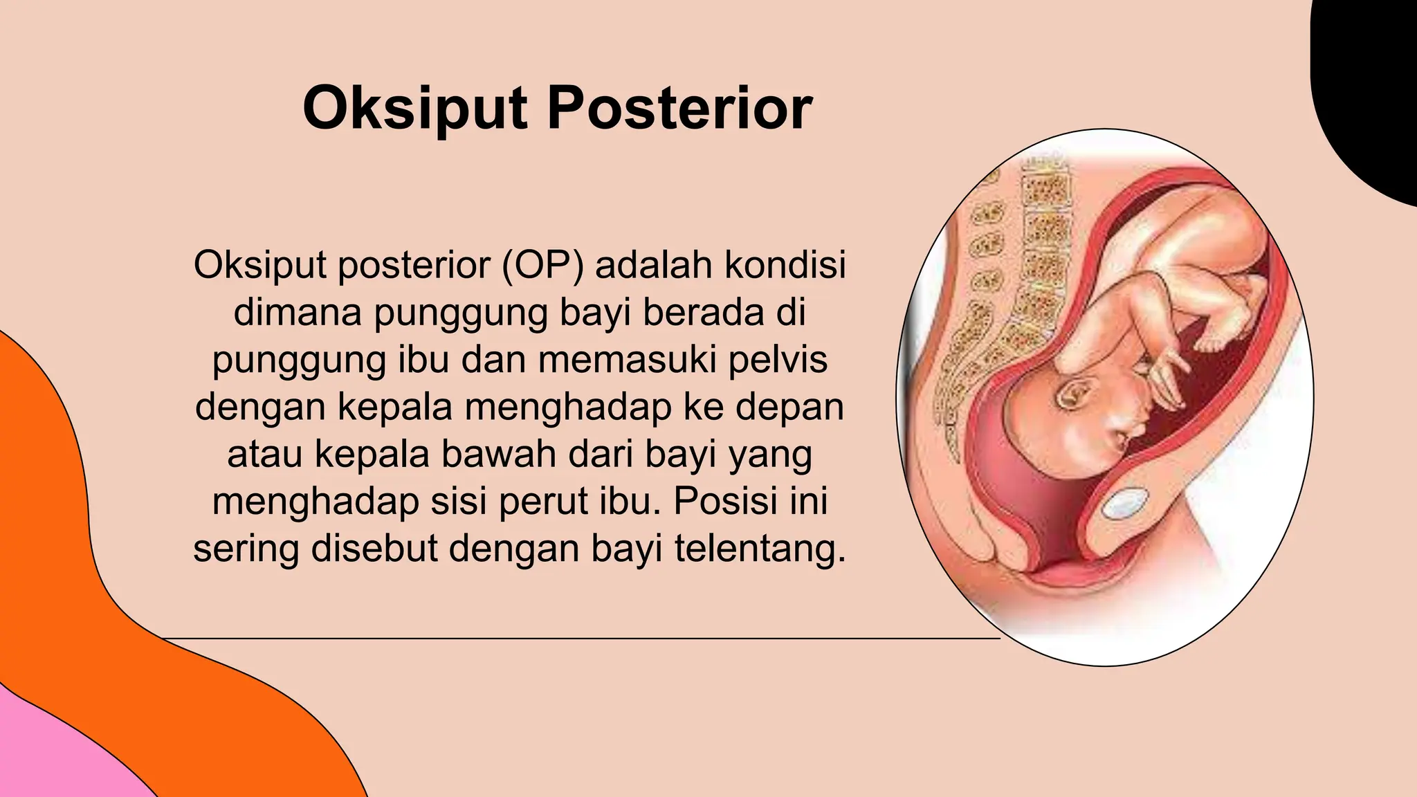 Mekanisme Persalinan Presentasi Oksiput Posteroir (1).pptx