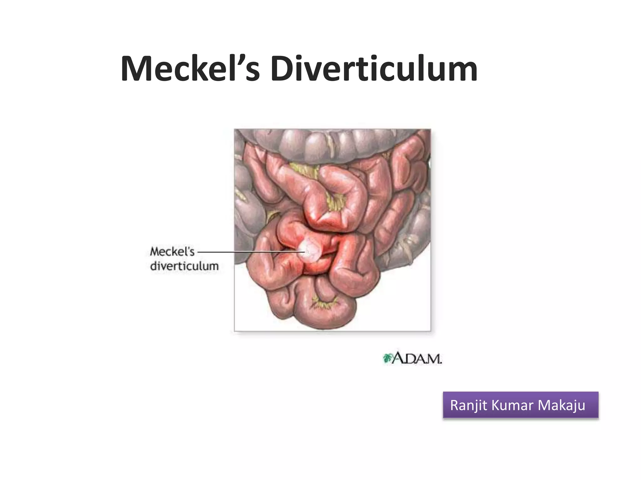 Mekel’s diverticulum | PPTX