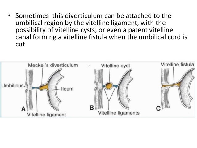 Mekel’s diverticulum