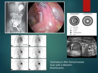 Mekelsdiverticulum. | PPTX