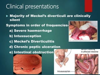 Mekelsdiverticulum. | PPTX