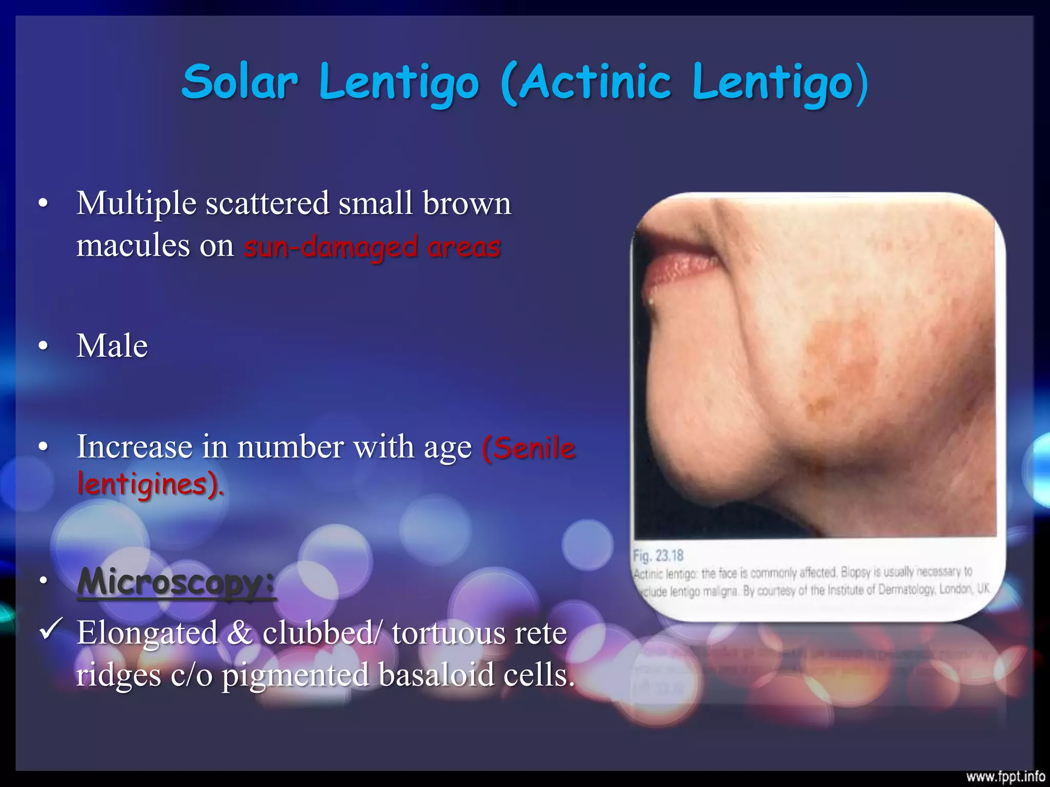 Melanocytic lesion of skin ( final) | PPTX