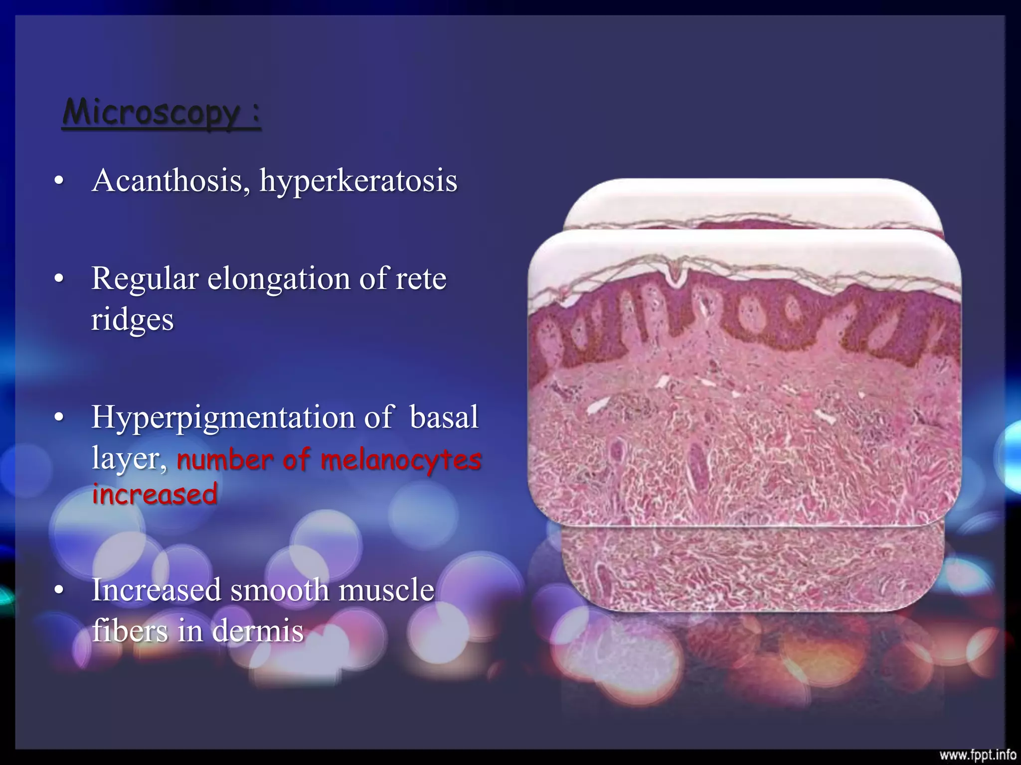 Melanocytic lesion of skin ( final) | PPTX