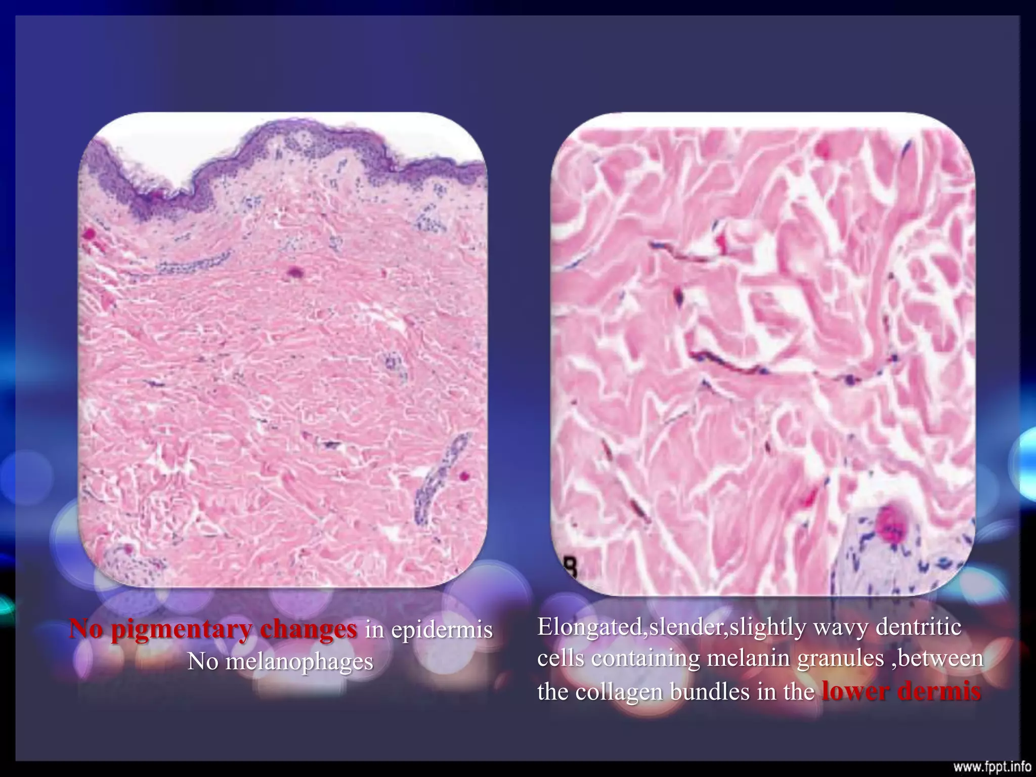 Melanocytic lesion of skin ( final) | PPTX