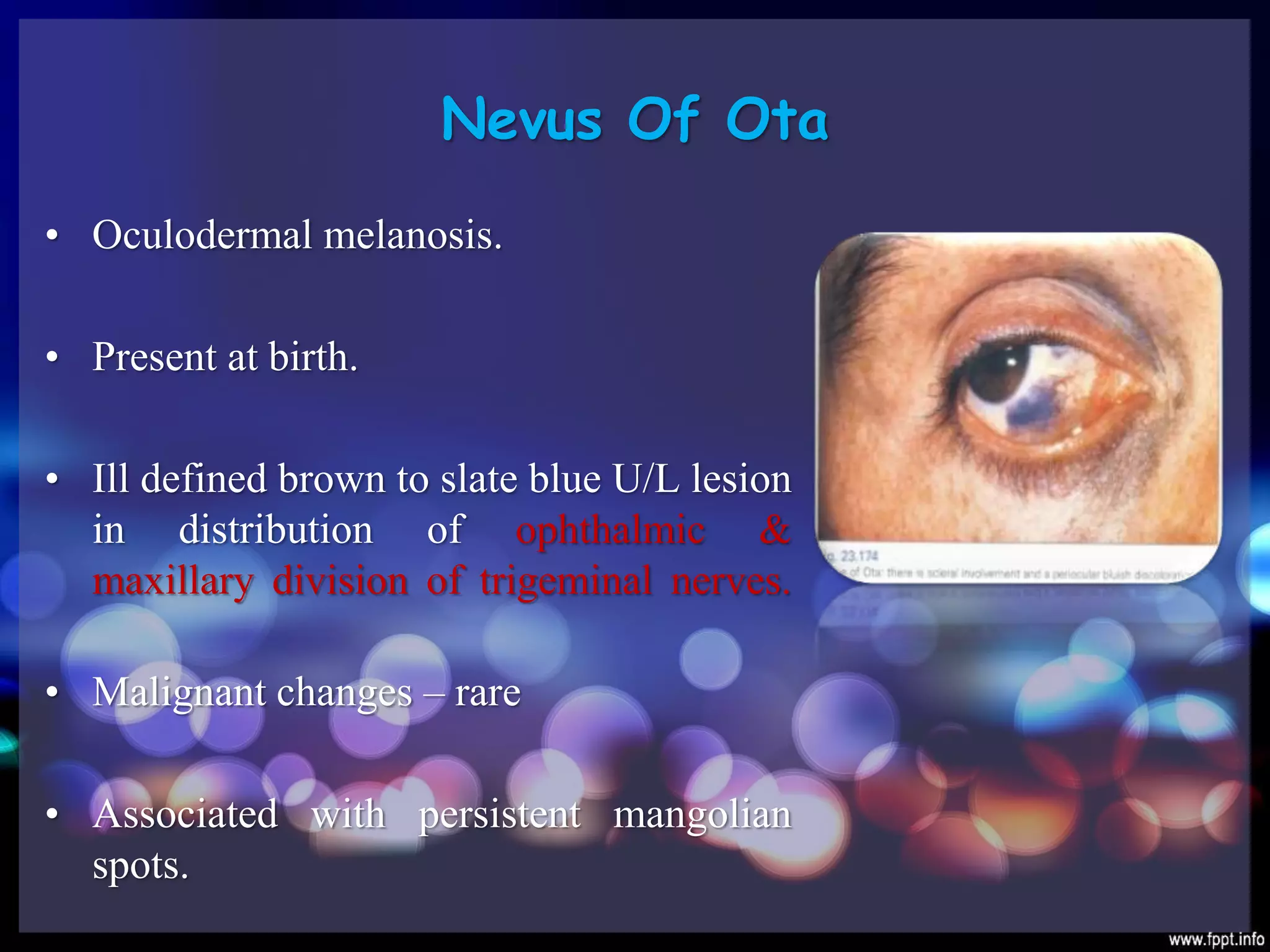 Melanocytic lesion of skin ( final) | PPTX