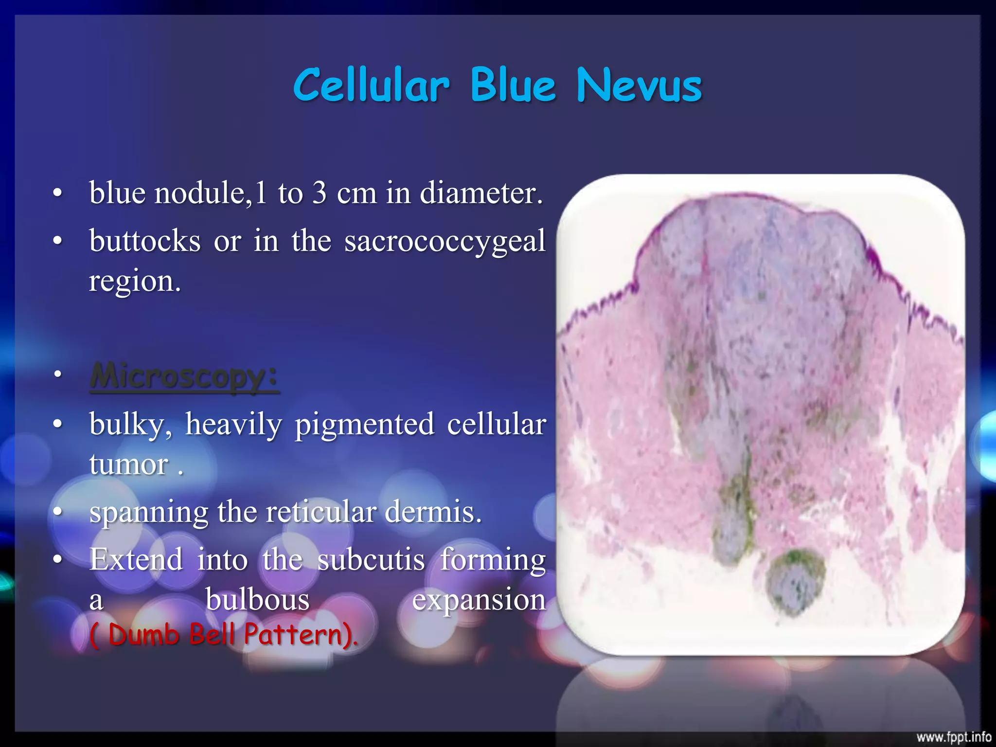 Melanocytic lesion of skin ( final) | PPTX