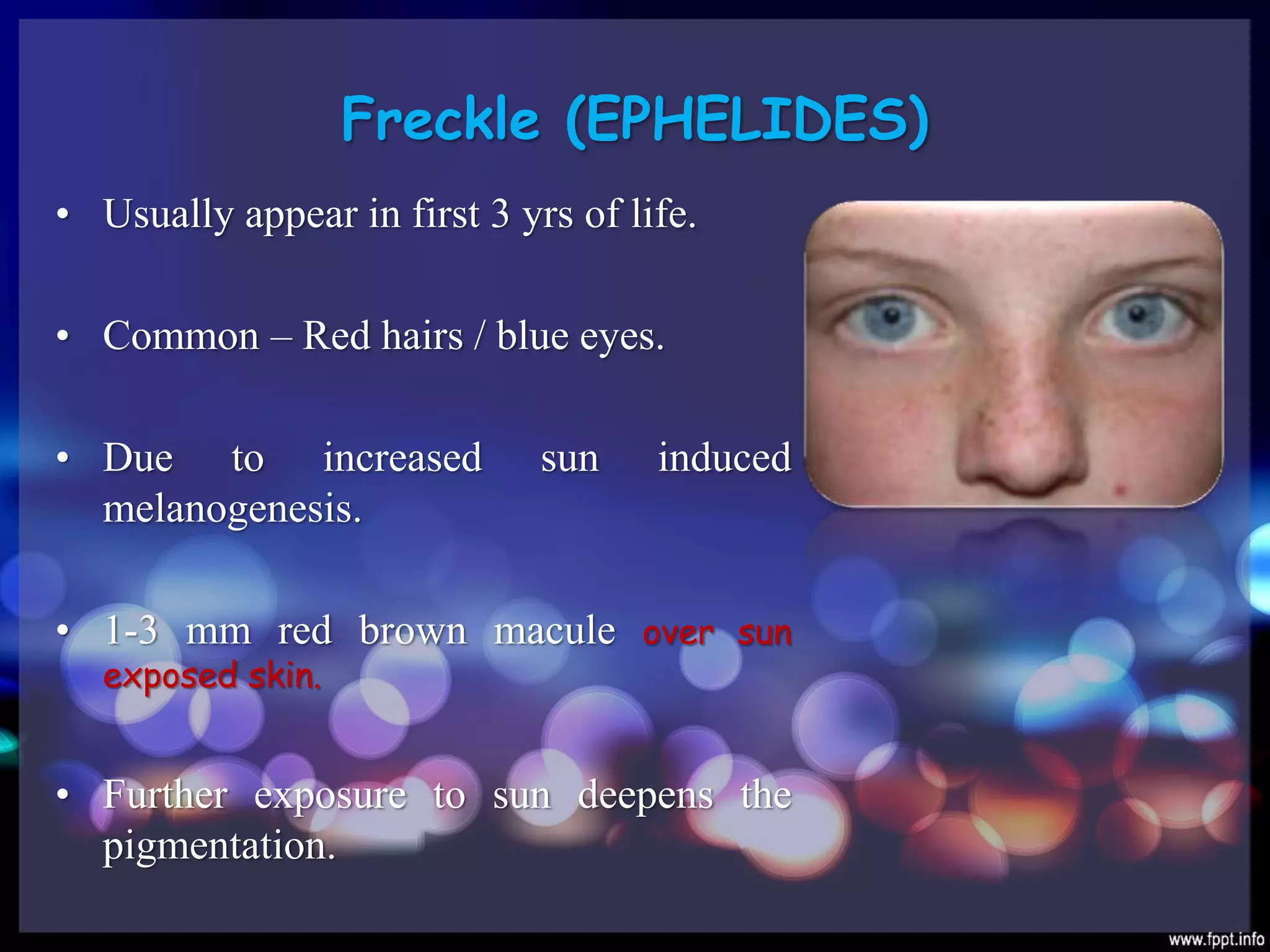 Melanocytic lesion of skin ( final) | PPTX
