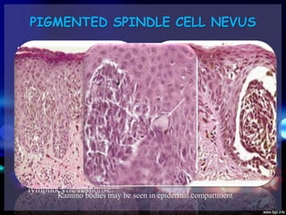 Melanocytic lesion of skin ( final) | PPTX