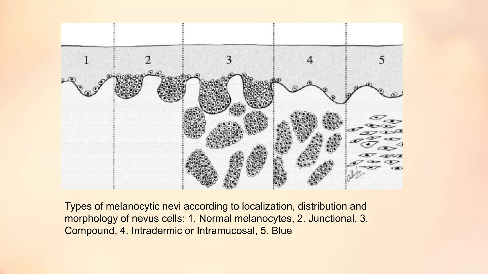 Melanocytic lesions. Pathology | PPTX