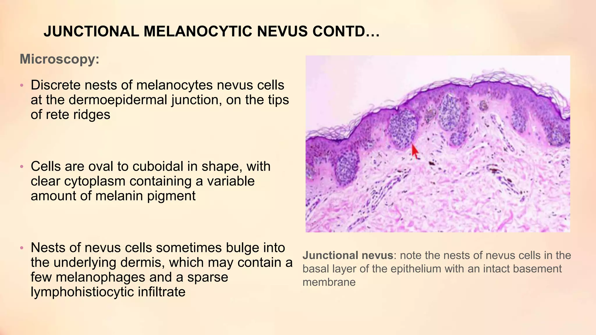 Melanocytic lesions. Pathology | PPTX