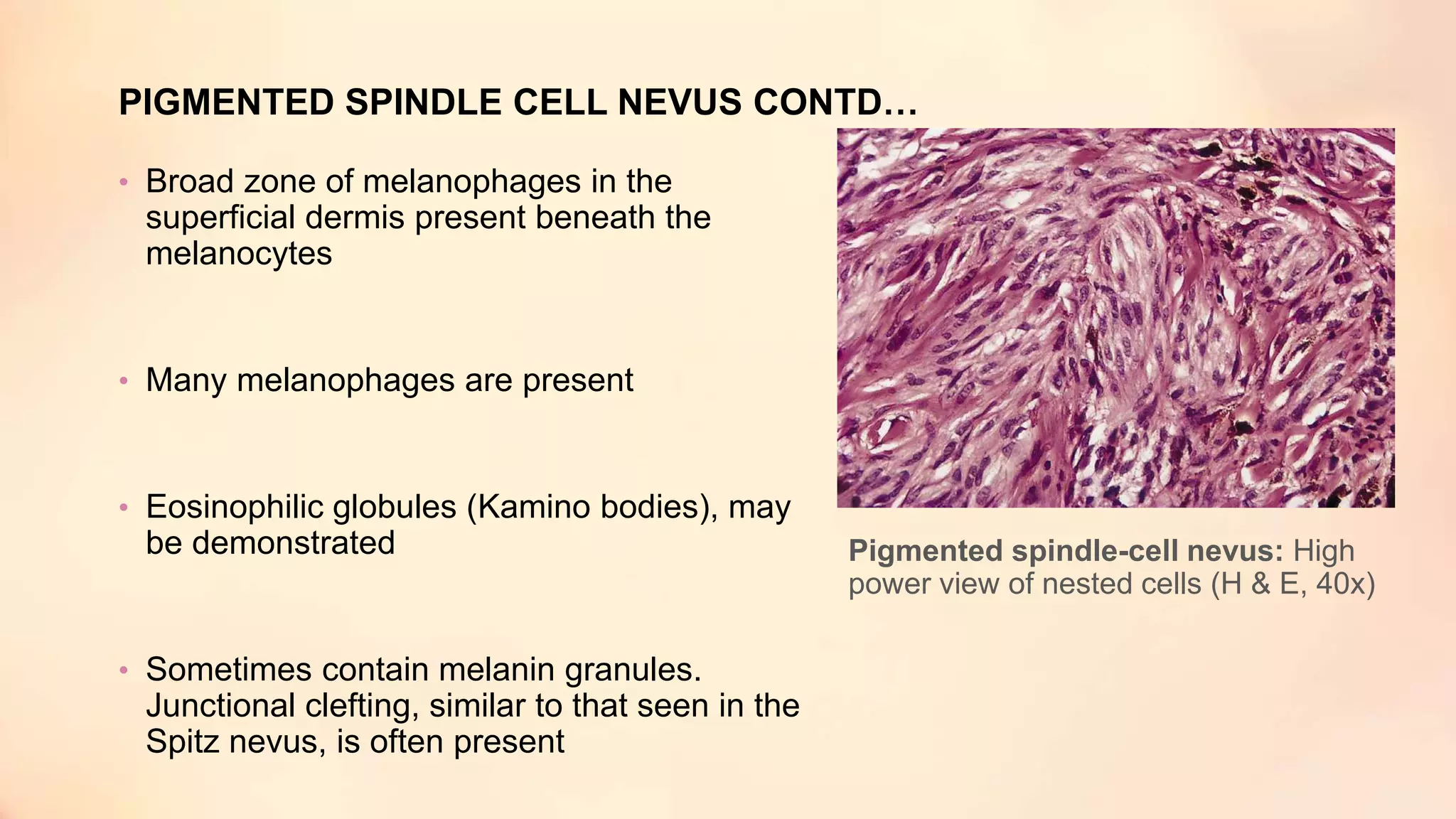 Melanocytic lesions. Pathology | PPTX