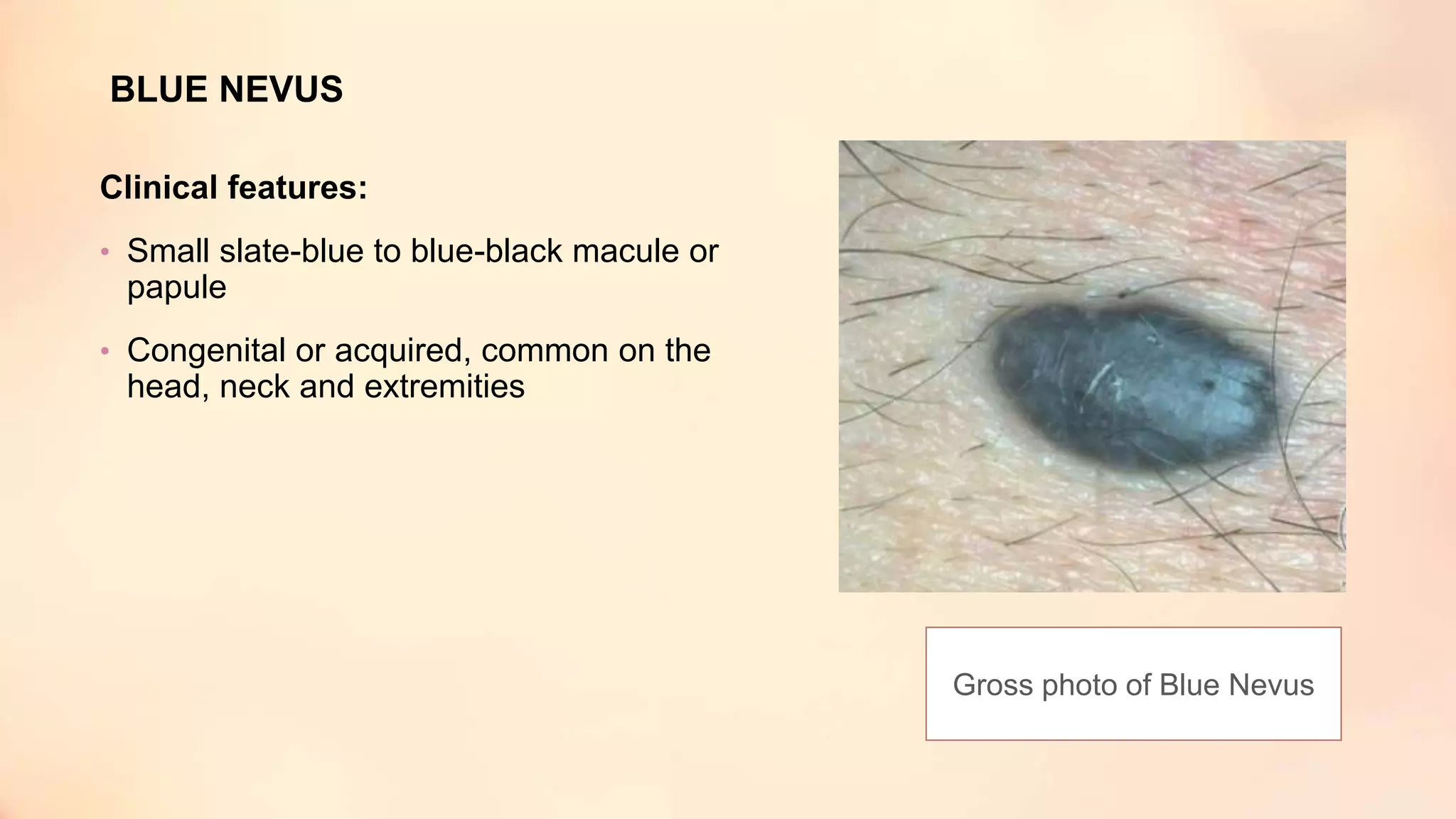 Melanocytic lesions. Pathology | PPTX