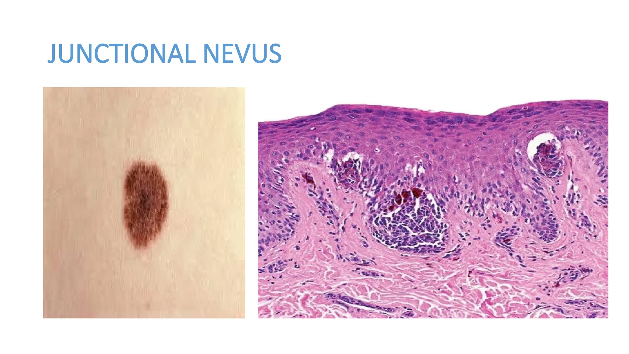 Congenital nevus Melonocytic nevus Birth marks | PPTX | Skin and ...