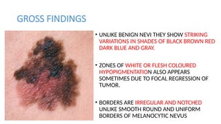 Congenital nevus Melonocytic nevus Birth marks | PPTX | Skin and ...