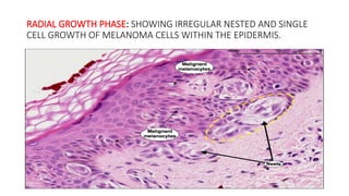 Congenital nevus Melonocytic nevus Birth marks | PPTX | Skin and ...