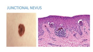 Congenital nevus Melonocytic nevus Birth marks | PPTX | Skin and ...