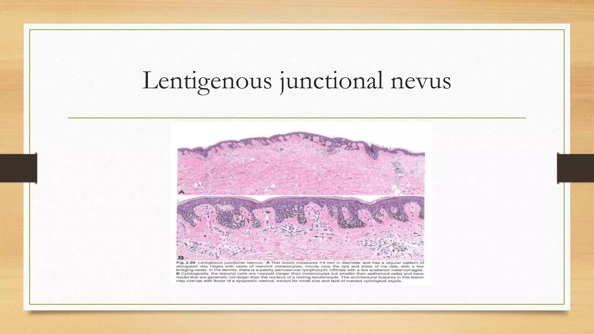 Melanocytic tumors-nevus and malignant melanoma | PPTX