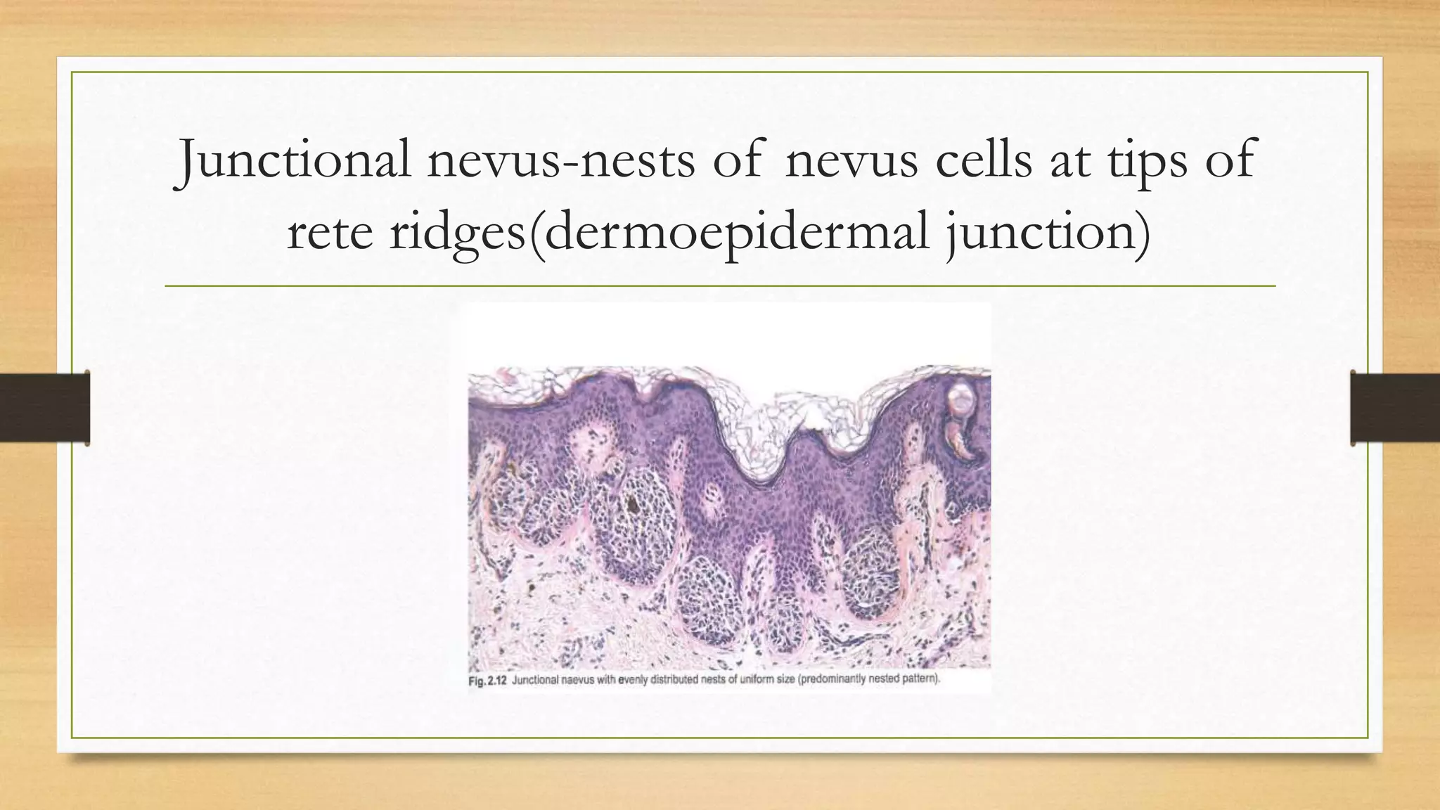 Melanocytic Tumors Nevus And Malignant Melanoma Pptx