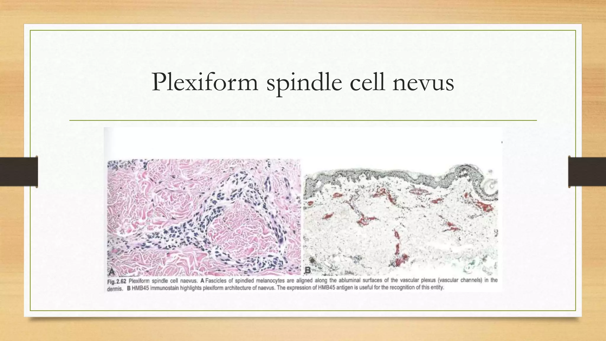 Melanocytic tumors-nevus and malignant melanoma | PPTX