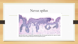 Melanocytic tumors-nevus and malignant melanoma | PPTX