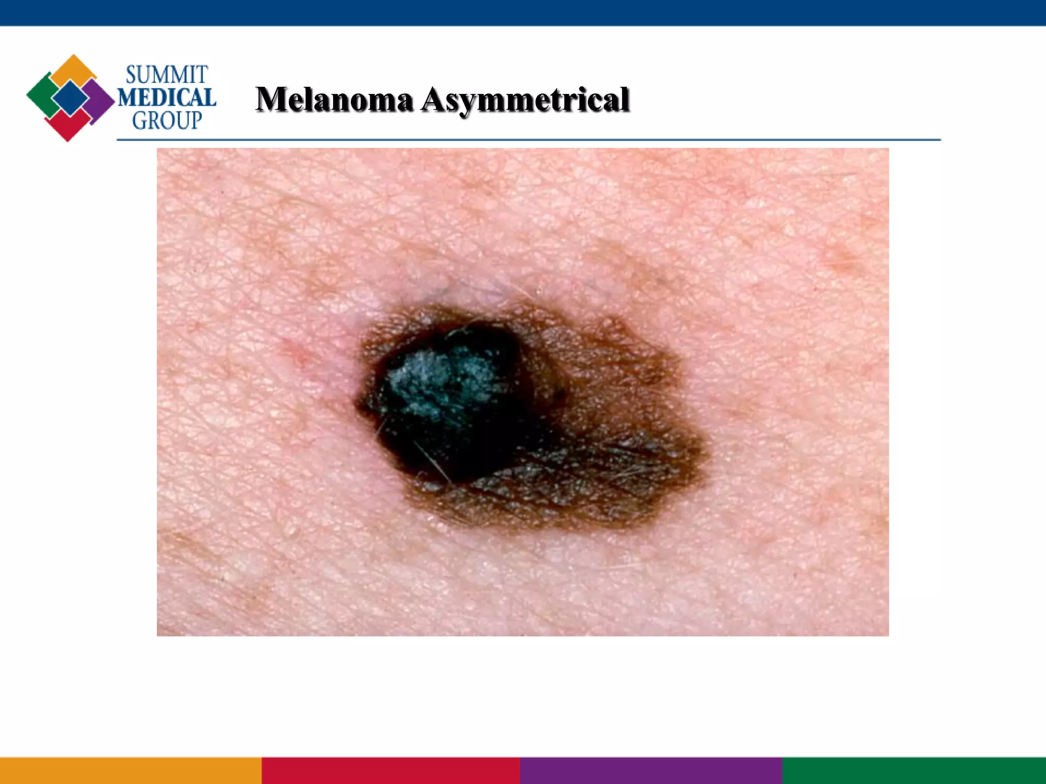 Melanoma – Prevention, Detection and Treatment | PPTX