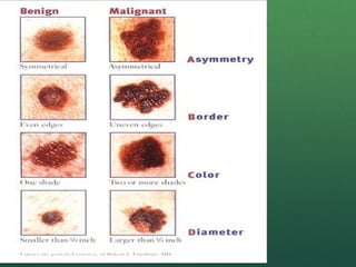 Melanoma | PPT