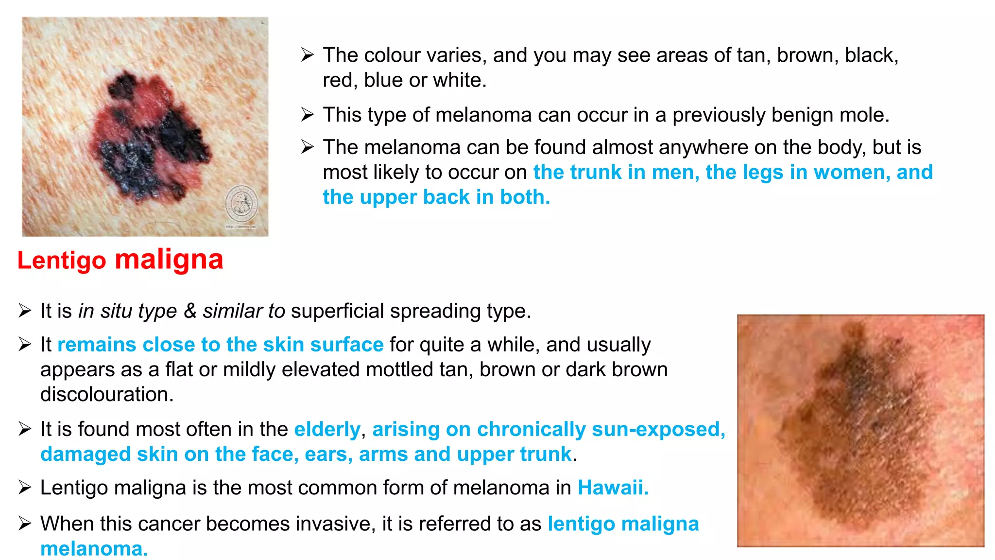 Melanoma | PPTX