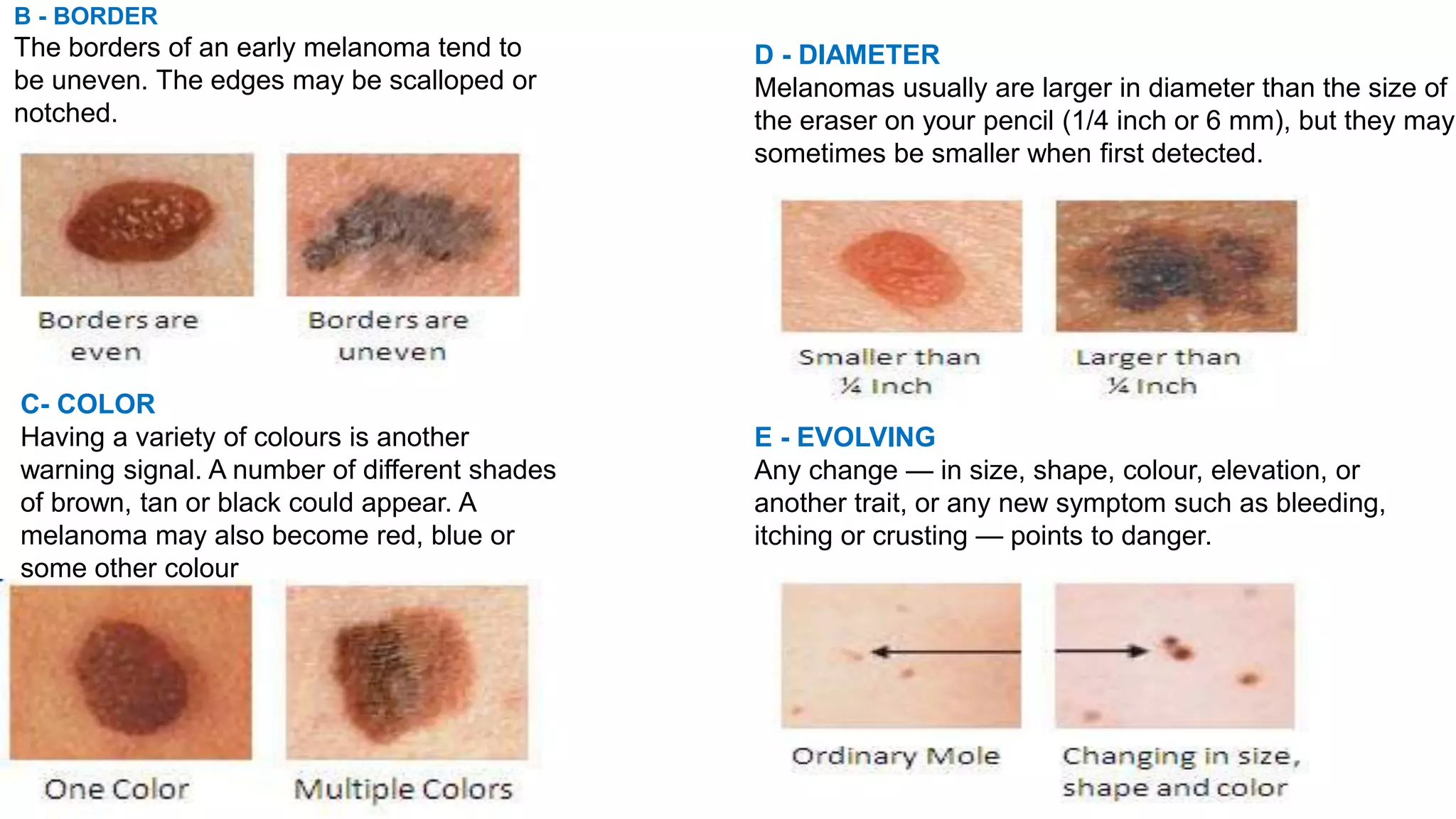Melanoma | PPTX